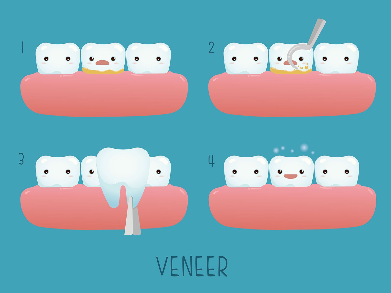 Sterling Smiles Azle | What are Veneers? Sterling Smiles Azle | What are Veneers?