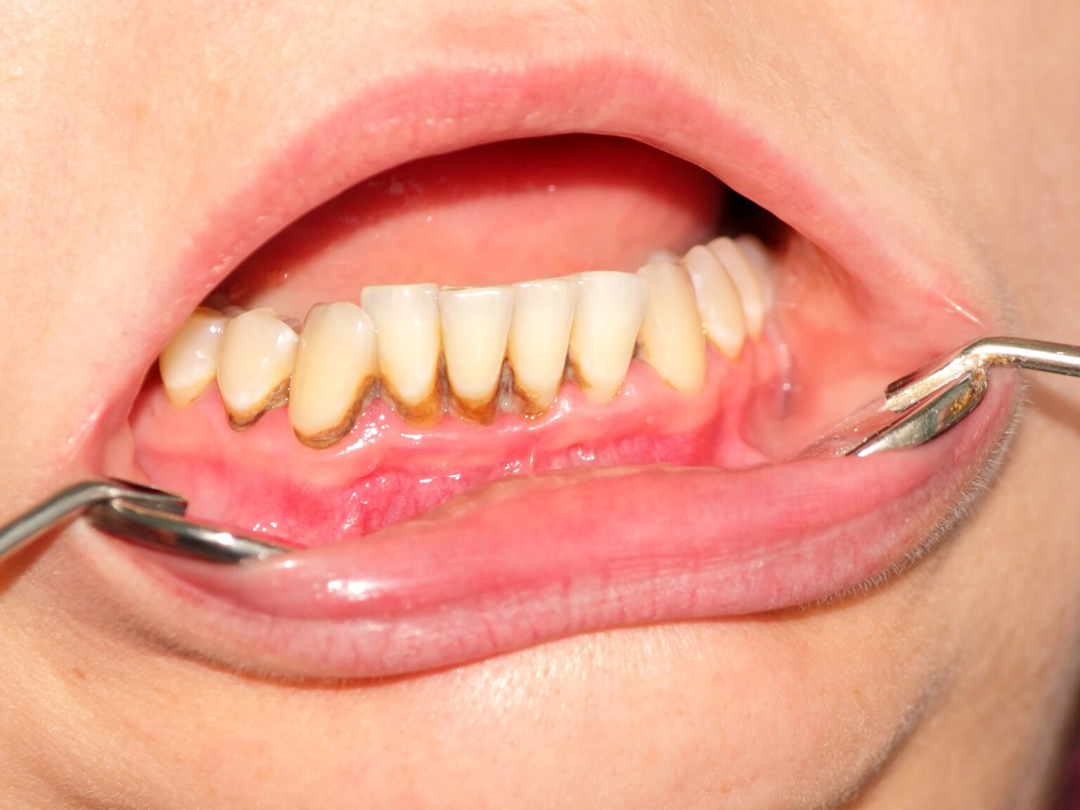Sterling Smiles Azle | What Is Black Tartar? Sterling Smiles Azle | What Is Black Tartar?